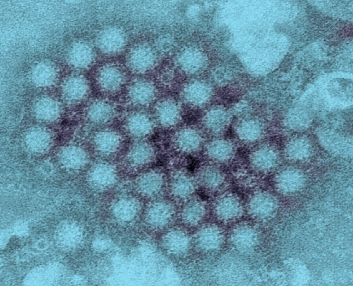 Norovirus illnesses are up in some places. Here’s what you need to know | PBS News