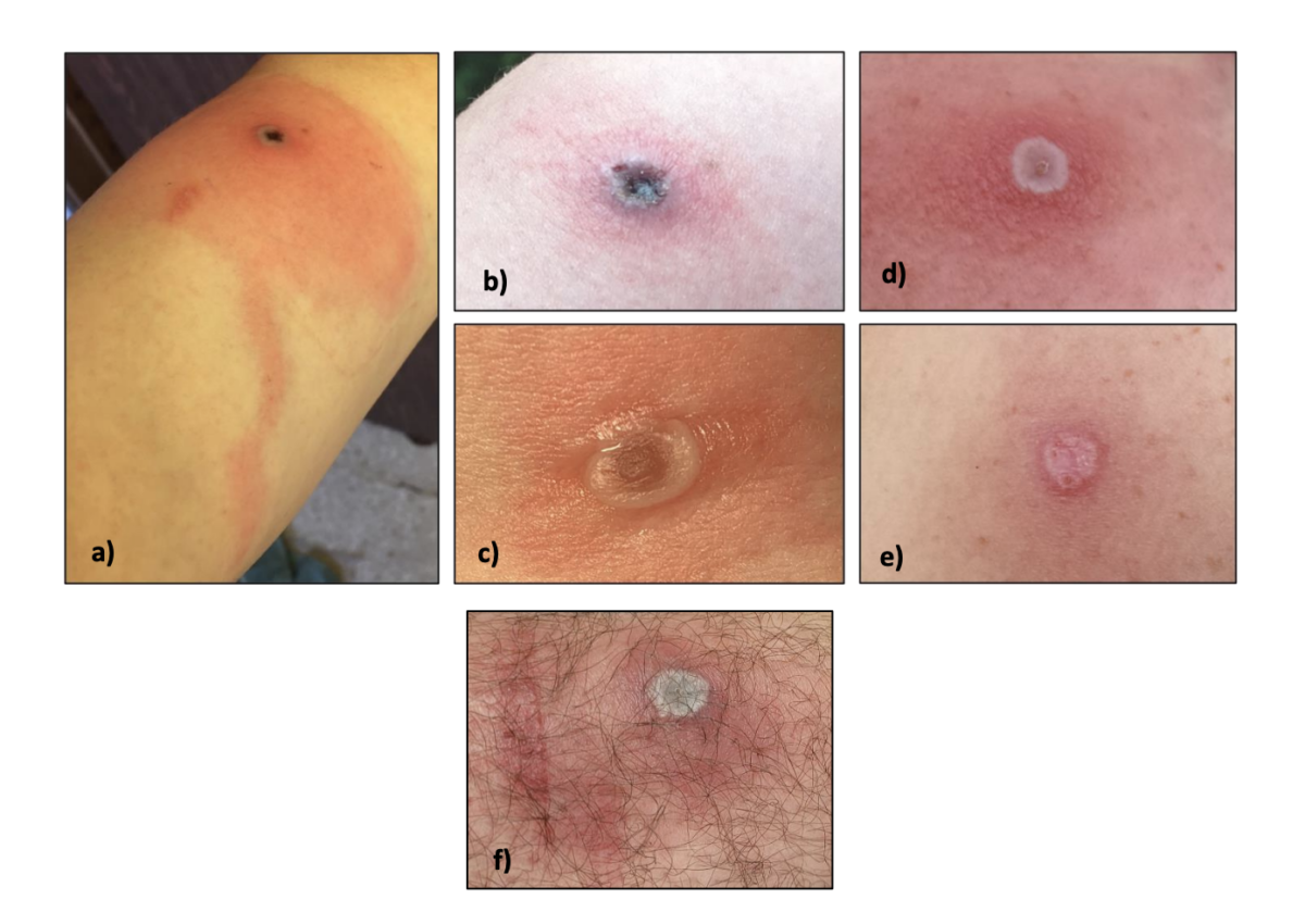 What is Alaskapox? Here’s a quick guide | PBS News