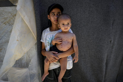 Skin diseases plague Palestinian children as infections run rampant in ...