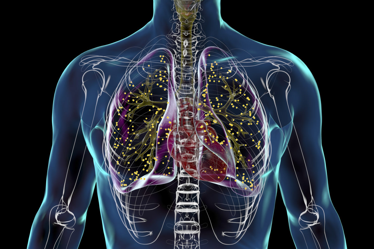 Tuberculosis was once a disease in decline, but a resurgence in cases ...