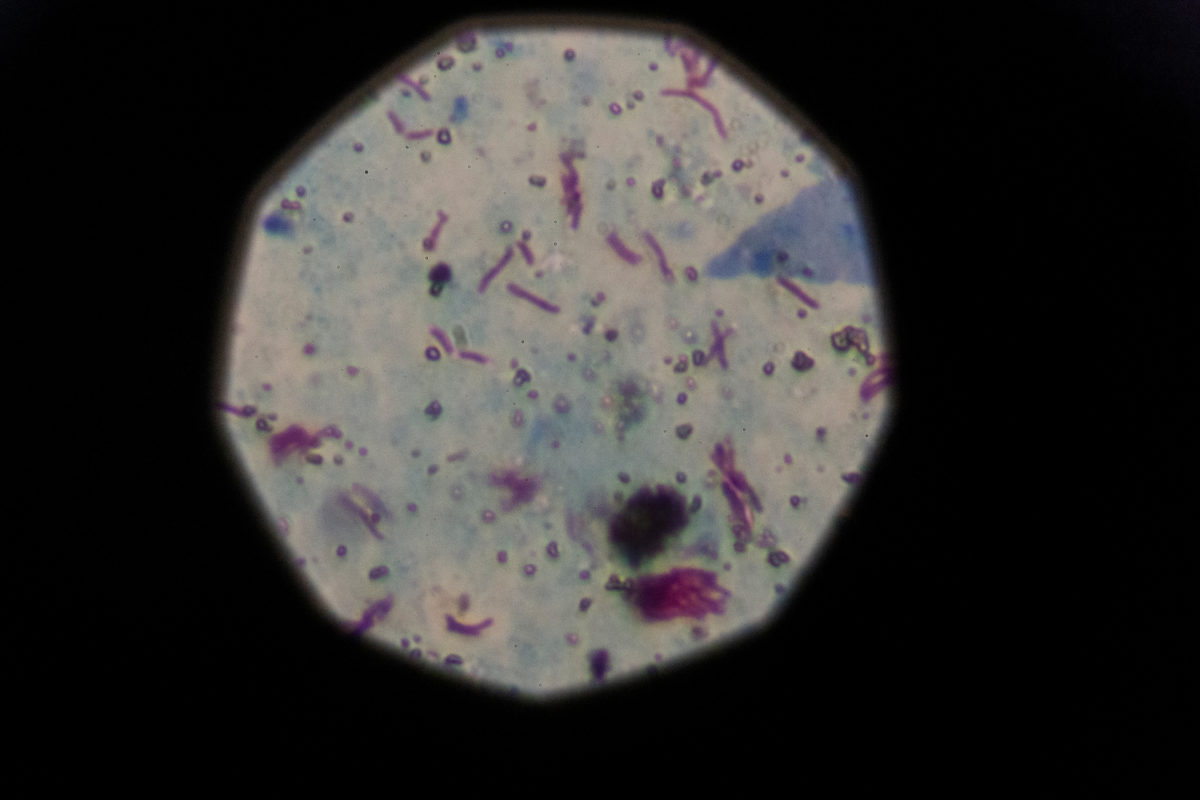 Global tuberculosis cases rise to a record, but deaths fall, reports ...